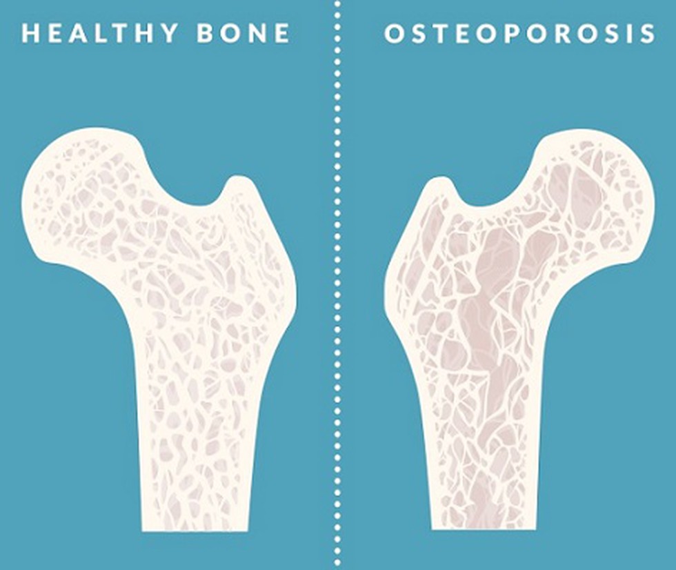 World Osteoporosis Day 2020 was observed on 20 October.
